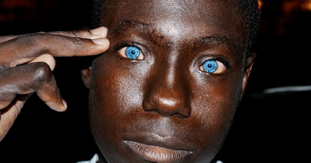 Des personnes ayant une génétique rare qui les rend uniques | Kueez